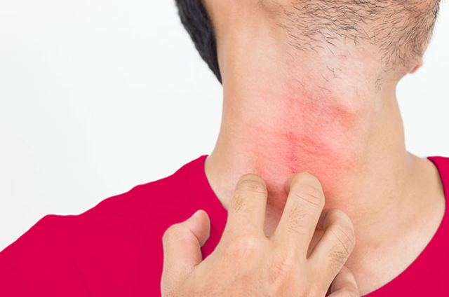 Alergi Dingin Mengintai di Musim Hujan! Kenali Sejumlah Gejalanya